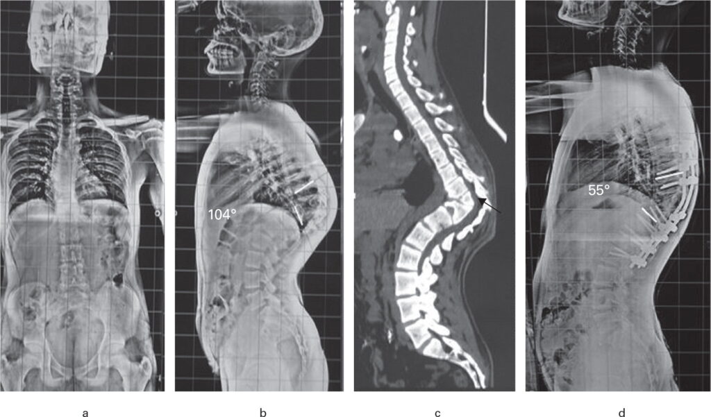 Cifosis congénita archivos - Dr. Domingo Pérez y Pérez / Especialista ...